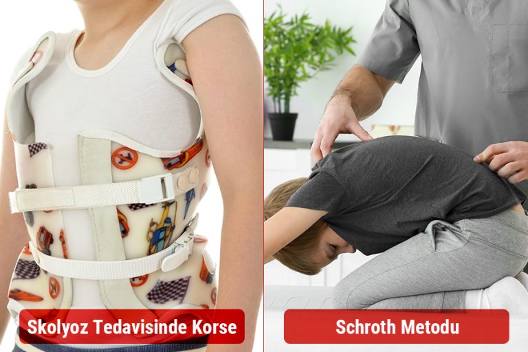 Skolyoz Nedir, Tedavisi ve Ameliyatı Nasıl Yapılır? Riskleri Nelerdir ...