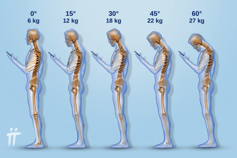 Boyun Düzleşmesi Nedir? Belirtileri, Teşhisi ve Tedavisi Turan&Turan