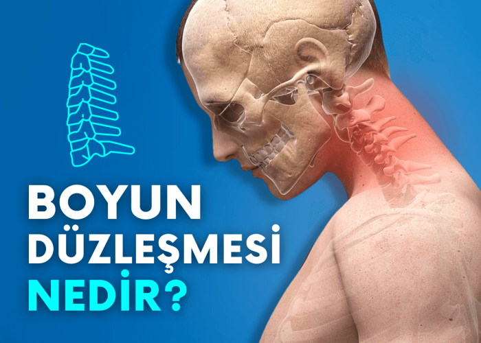 Boyun Düzleşmesi Nedir? Belirtileri, Teşhisi ve Tedavisi Turan&Turan