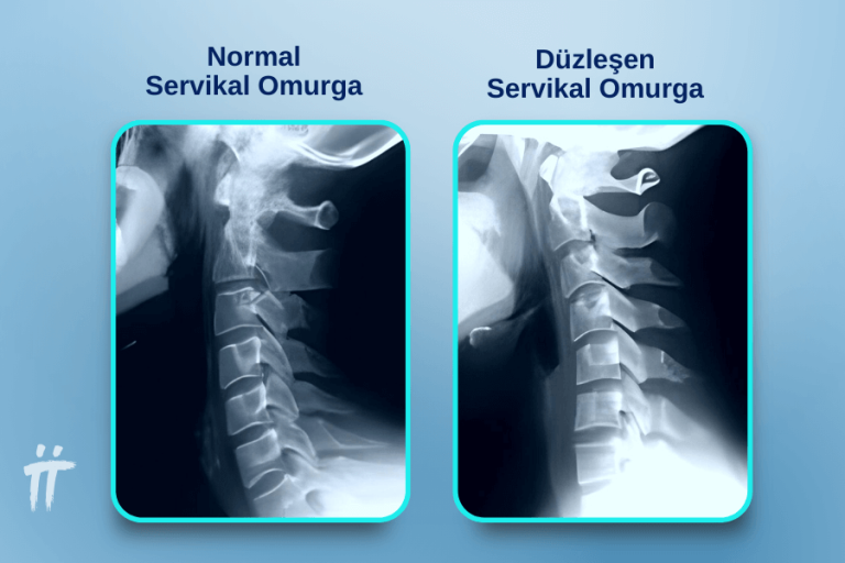 Boyun Düzleşmesi Nedir? Belirtileri, Teşhisi ve Tedavisi Turan&Turan