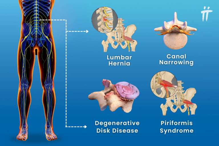 What is Sciatica? What is good for sciatica pain? Turan&Turan