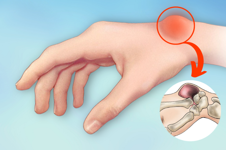 Ganglion Kisti, Belirtileri ve Tedavi Yöntemleri Hakkında Merak ...