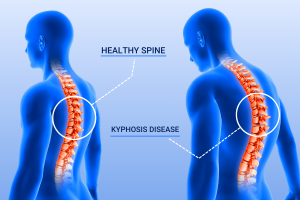 What is Kyphosis (Hunchback)? Treatment & Surgery Turan&Turan