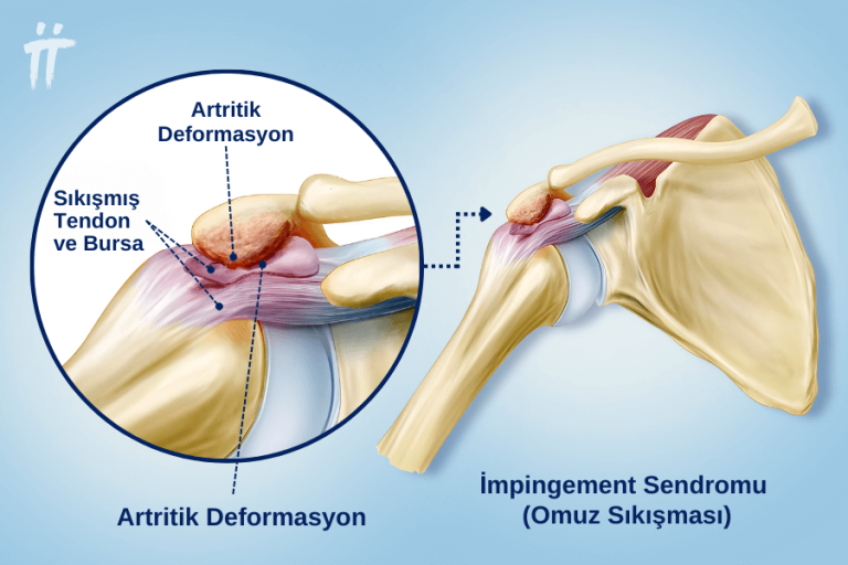 İmpingement Sendromu: Omuz Sıkışması Nedir? Belirtileri ve Tedavisi Turan&Turan