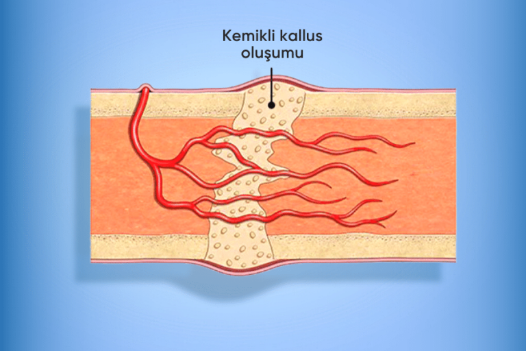 Kemiğin Yapısı ve Kemik Kırığı İyileşme Süreci Turan&Turan