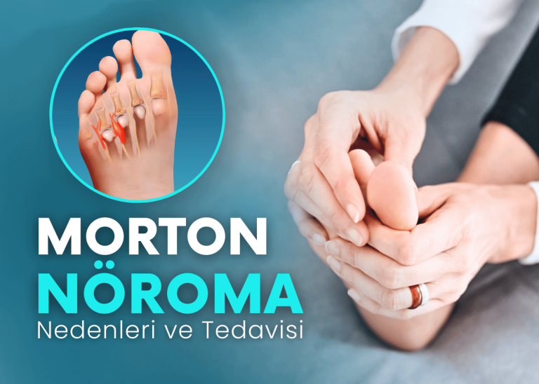 Morton Nöroma: Belirtileri ve Tedavisi Turan&Turan