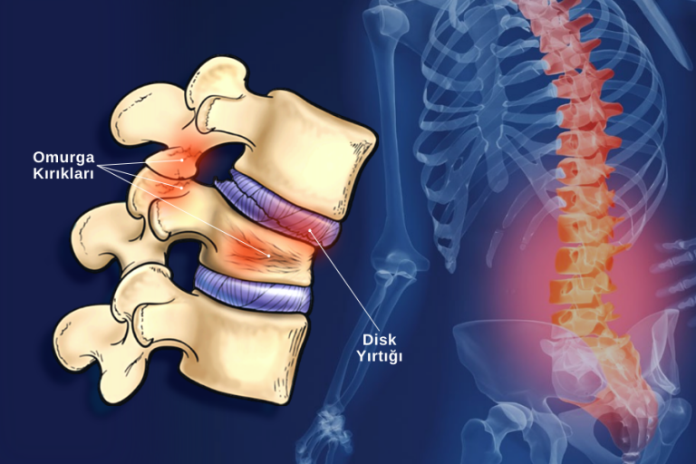 Omurga Kırıkları ve Omurga Kırığı Ameliyatı Turan&Turan