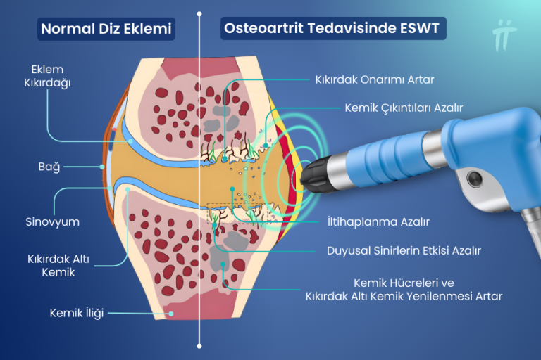 ESWT Nedir? Şok Dalga Tedavisi Hangi Ağrılara İyi Gelir? Turan&Turan
