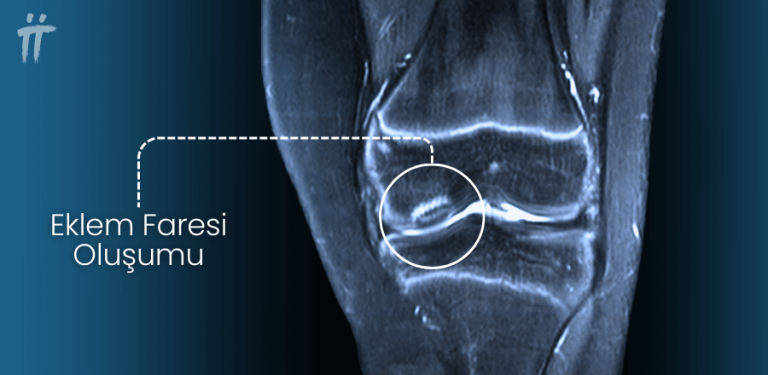 Eklem Faresi Nedir? Belirtileri ve Tedavi Yöntemleri Turan&Turan