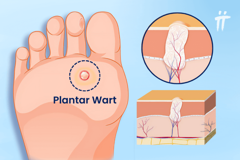 Plantar Warts: Treatments & Removal Turan&Turan