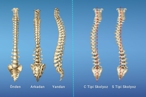 Skolyoz Egzersizleri ve Schroth Metodu Turan&Turan