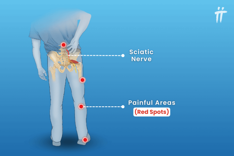 What is Sciatica? What is good for sciatica pain? Turan&Turan