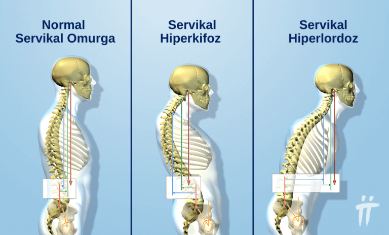 Boyun Düzleşmesi Nedir? Belirtileri, Teşhisi ve Tedavisi Turan&Turan