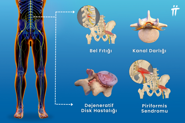Siyatik Nedir? Siyatik Ağrısına Ne İyi Gelir? Turan&Turan