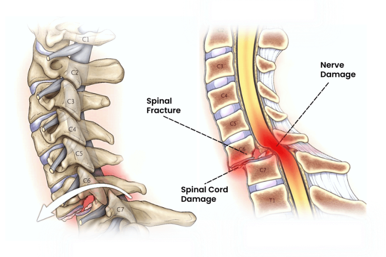 Spine Fractures and Spine Fracture Surgery Turan&Turan