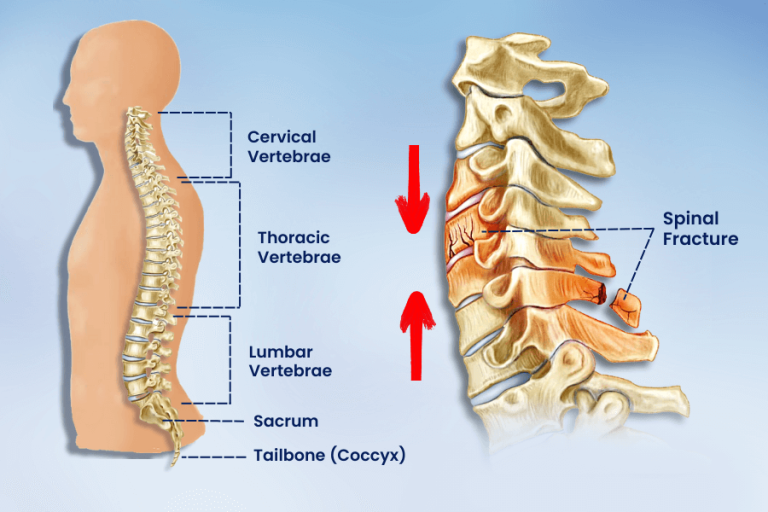 Spine Fractures and Spine Fracture Surgery Turan&Turan