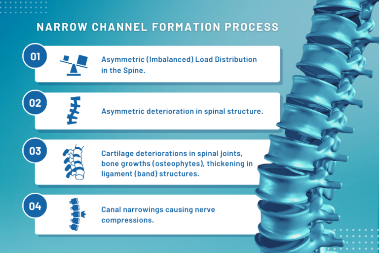 What is Spinal Stenosis? Turan&Turan