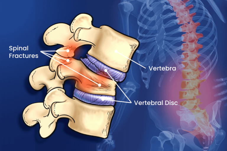 Spine Fractures and Spine Fracture Surgery Turan&Turan