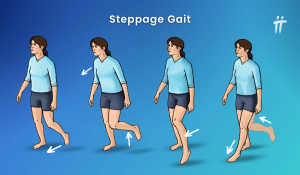 What is Gait Disorder and Why Does It Occur? Turan&Turan