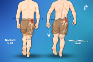 What is Gait Disorder and Why Does It Occur? Turan&Turan