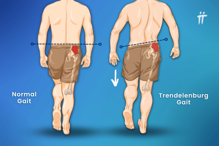 What is Gait Disorder and Why Does It Occur? Turan&Turan